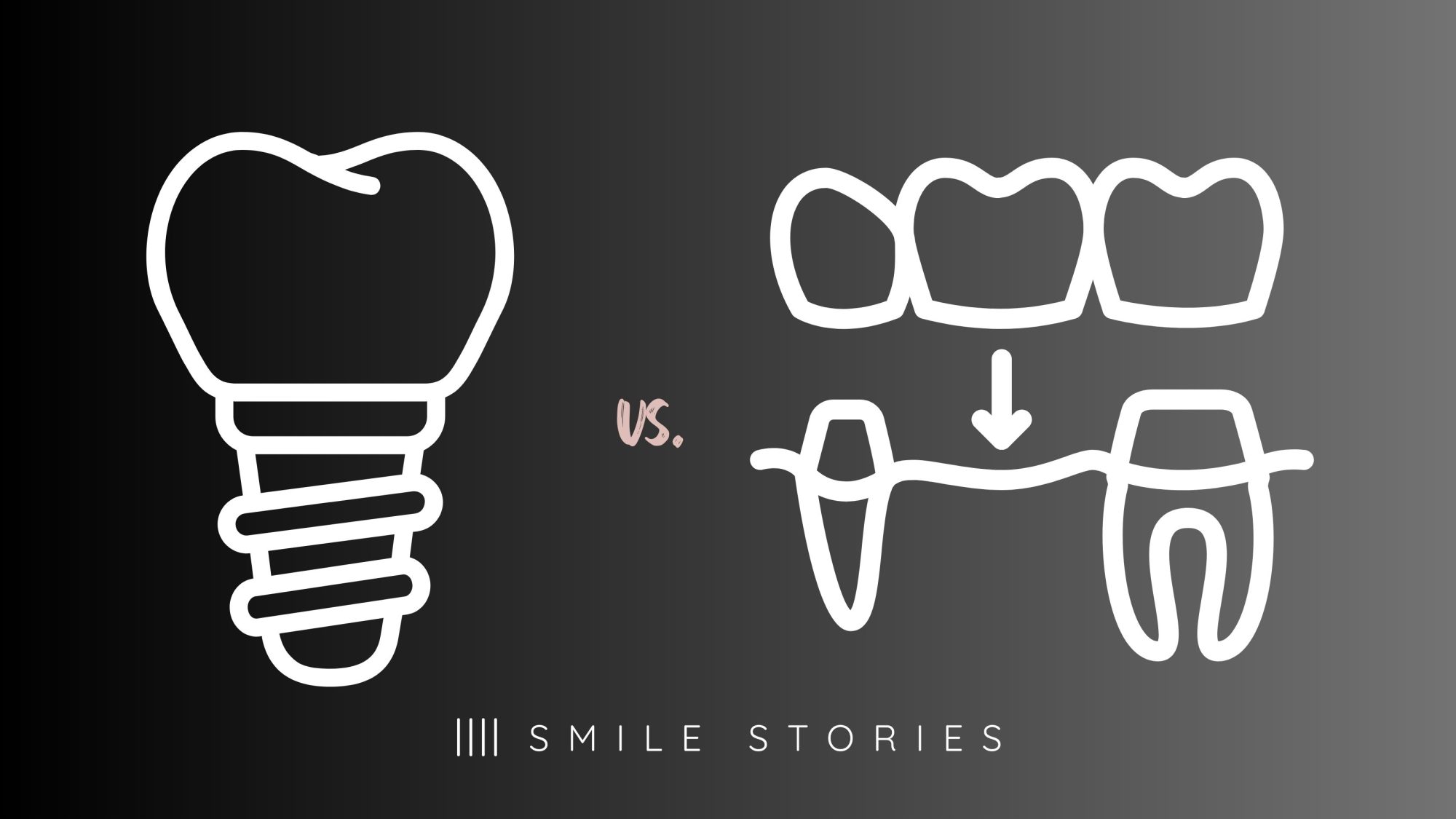 Difference Between Dental Implant And Bridge Bournemouth