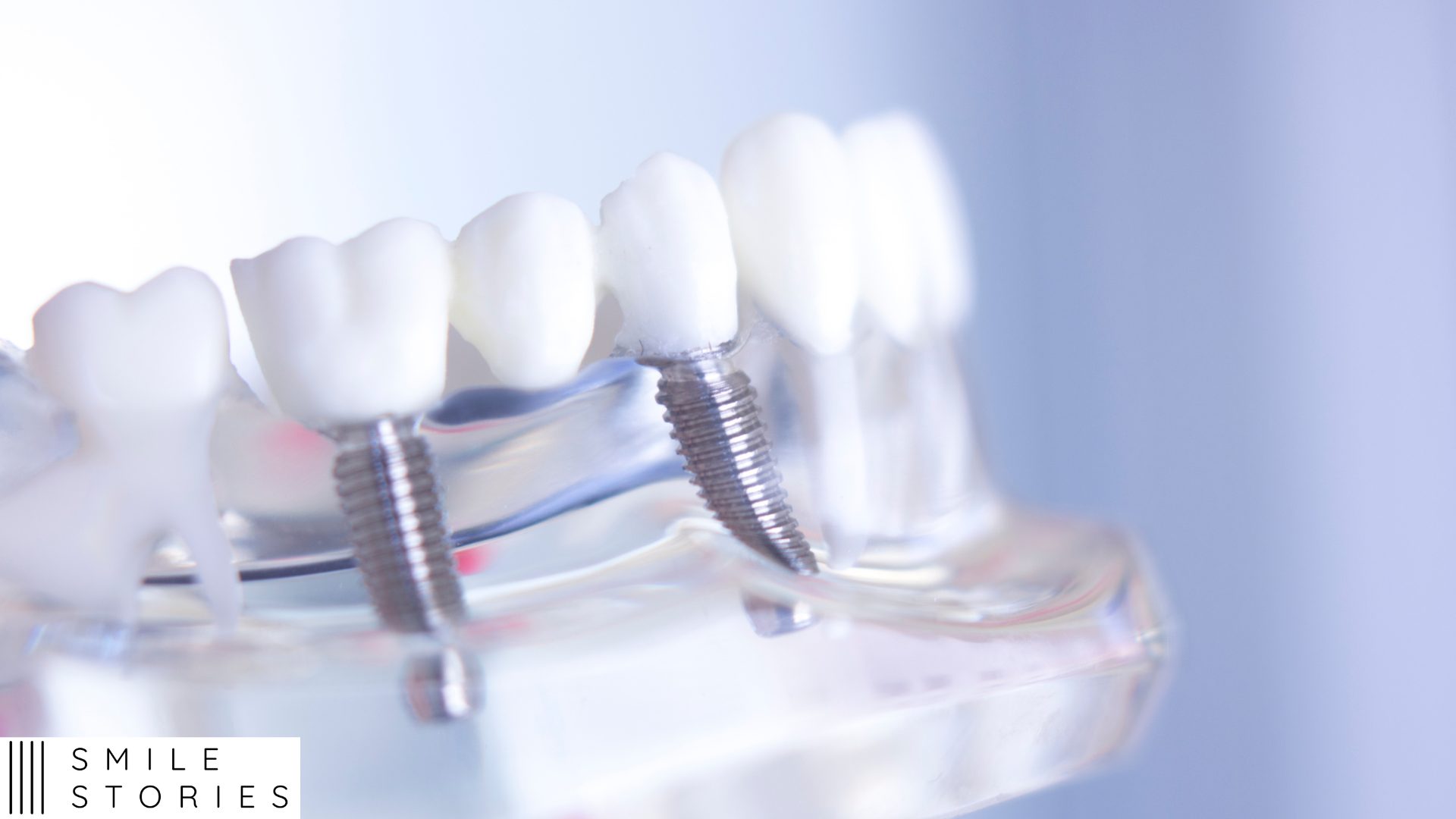 Talking Freely with Multiple Dental Implants in Dorset