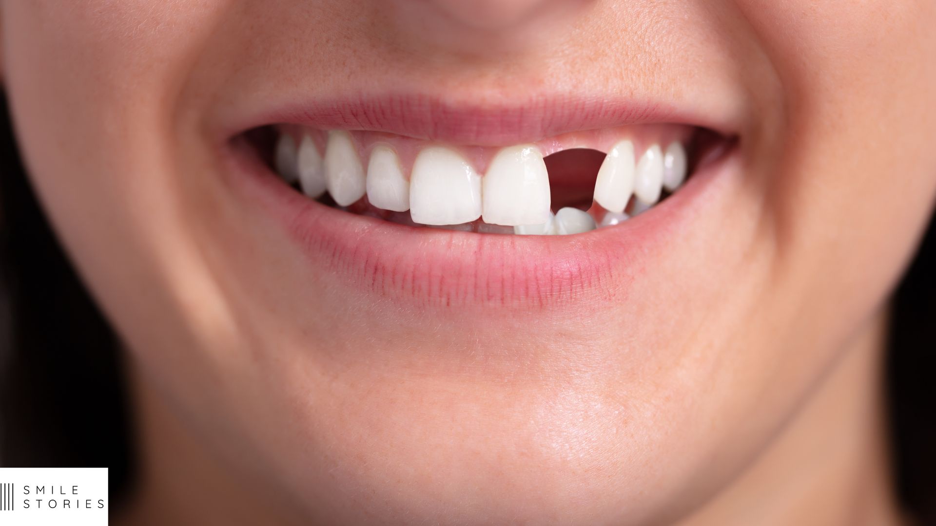 How Missing Teeth Lower Confidence in Salisbury