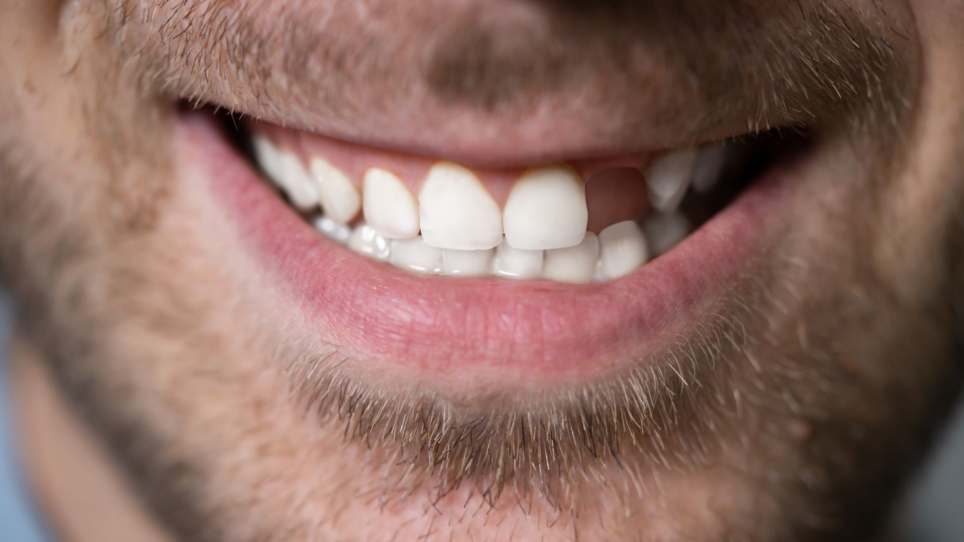 Creative Solutions for Missing Teeth in Salisbury